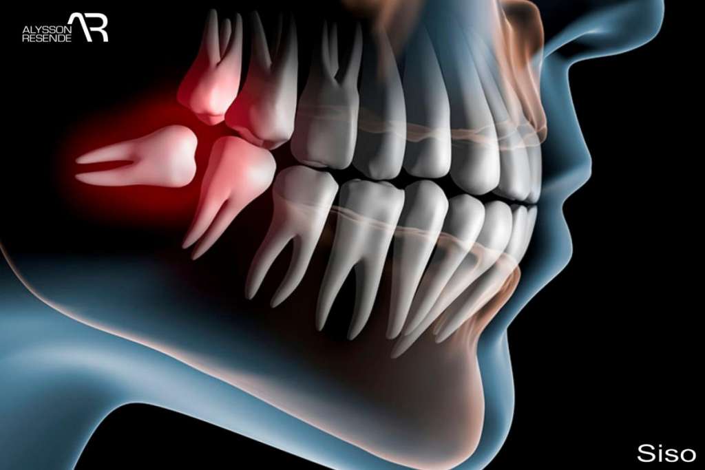 [Bhaz Saúde] Oito razões para você remover o seu Siso agora