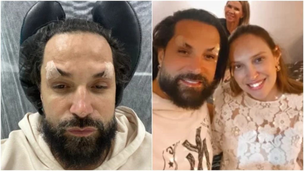 Resultado de harmonização facial de Latino surpreende internautas